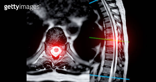 MRI T-L spine or Thoracosacral spine Axial and sagittal T2 technique ...