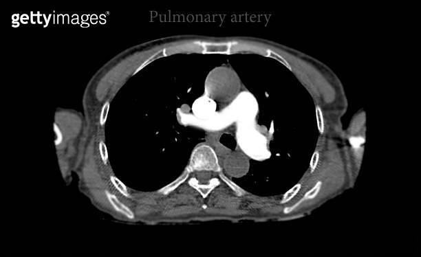 CTPA or CTA pulmonary artery for diagnostic Pulmonary embolism (PE ...