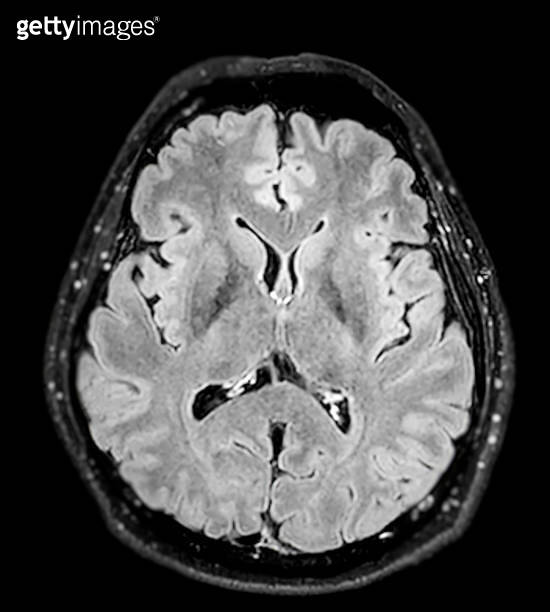 MRI brain scan Axial flair plane for detect Brain diseases sush as ...