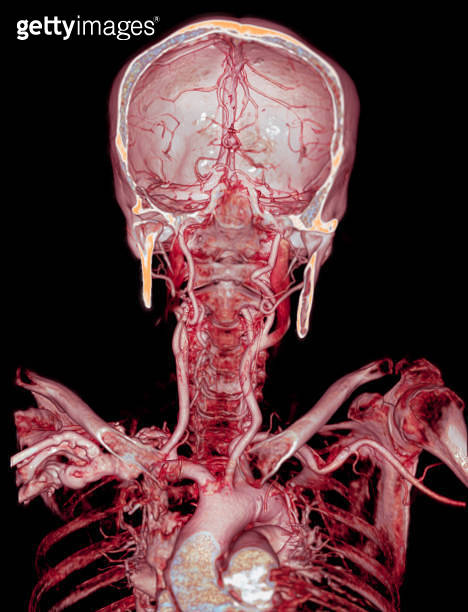 CTA brain and carotid artery or CT angiography of the brain 3D ...