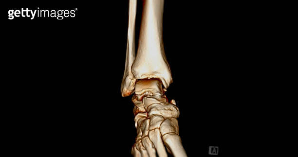 Ct Scan Ankle Joint Or Computed Tomography Of Ankle Joint 3d Rendering Image 이미지 1695054928