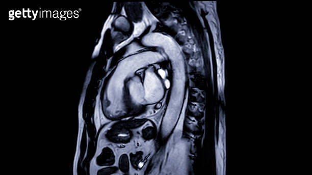 MRI heart or Cardiac MRI ( magnetic resonance imaging ) of heart for ...