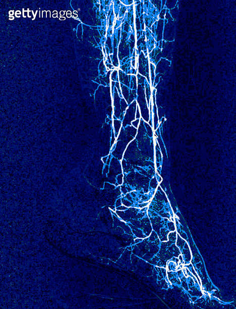 Foot angiorgam or Plantar angiogram angiogram showing Plantar and ...
