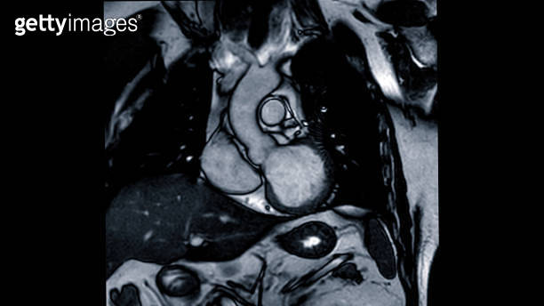 MRI heart or Cardiac MRI ( magnetic resonance imaging ) of heart in ...