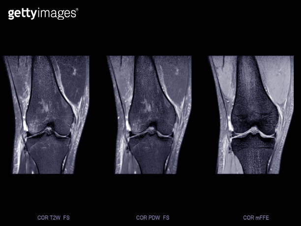 Magnetic resonance imaging or MRI of knee joint Corona; T2 FS , PDW and ...
