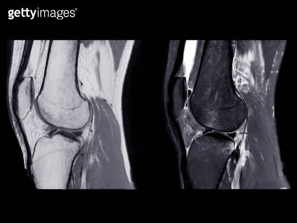 Magnetic resonance imaging or MRI of knee joint Sagittal PDW and T2 FS ...