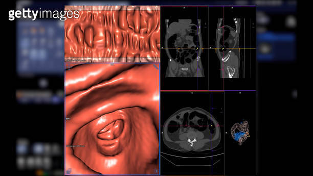 CT colonography compare 2D Axial,sagittal ,coronal plane and 3D ...
