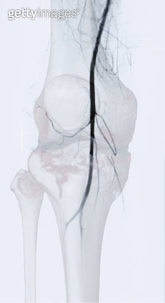 A Femoral Angiogram is a medical procedure used to visualize blood ...