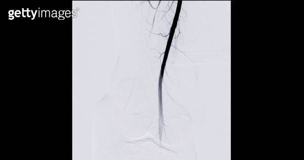 A Femoral Angiogram is a medical procedure used to visualize blood ...
