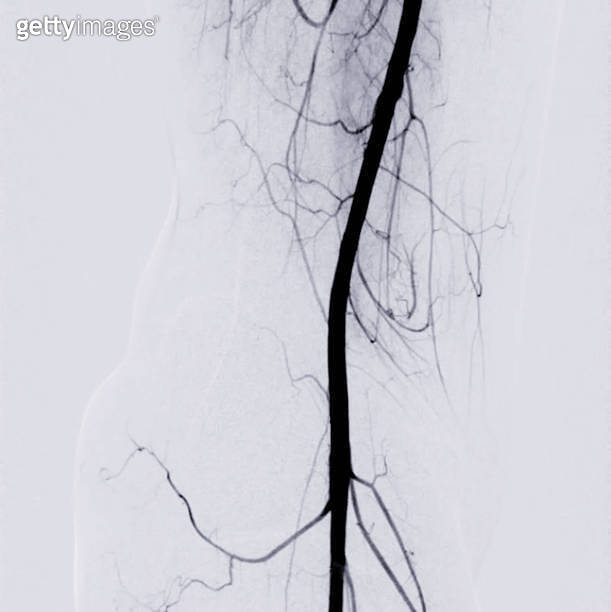A Femoral Angiogram is a medical procedure used to visualize blood ...