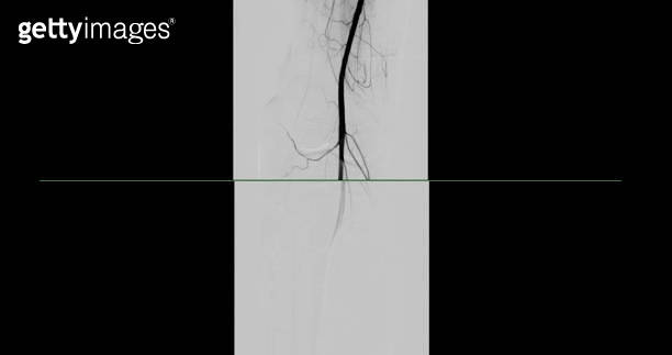 A Femoral Angiogram is a medical procedure used to visualize blood ...