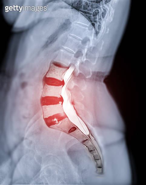 X-ray image of lumbar Spine or L-s spine lateral view with MRI l-s ...