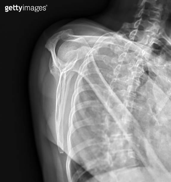 X-ray Shoulder joint shoulder front view for diagnosis fracture of ...