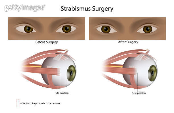 Strabismus or Squint surgery treats misaligned eyes. Eye Muscle Surgery ...