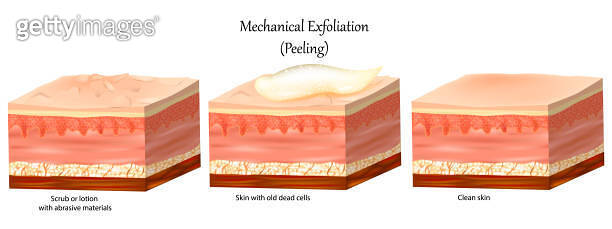 Mechanical Exfoliation or Peeling. Skin care. Cross-section of a skin ...