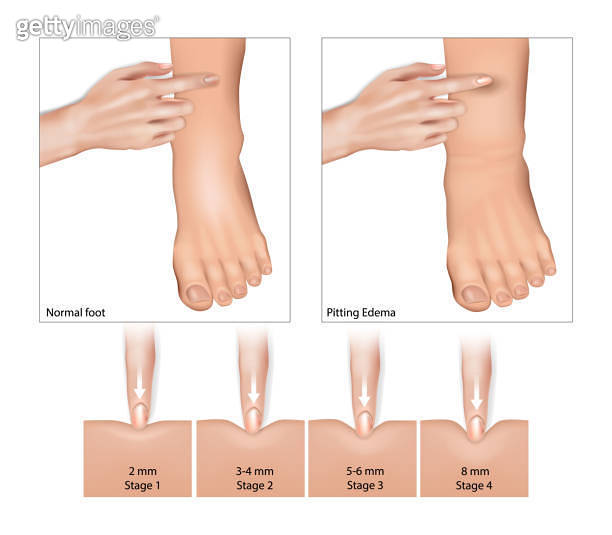 Pitting Edema and Normal foot. Oedema, fluid retention, water retention ...