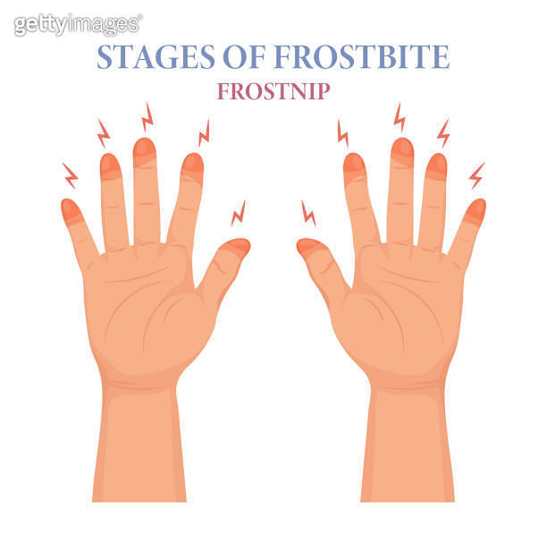 Frozen hands in different stages. Medical frostbite. Stages of ...