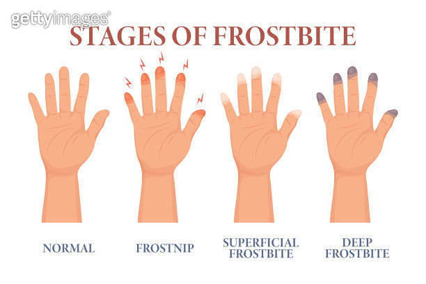 Frostbite stages. Frozen hands in different stages. Medical frostbite ...