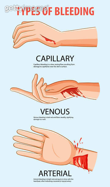 Illustration of Human Hand with Different Types of Bleeding (1620248428 ...
