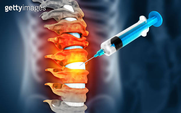 3d illustration of a lumbar spine injection 이미지 (1488354080) - 게티이미지뱅크