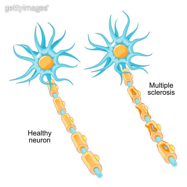 Multiple sclerosis. autoimmune disease (1492957945) - 게티이미지뱅크