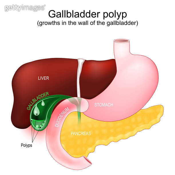 Cross section of a Gallbladder with polyps (1461075842) - 게티이미지뱅크