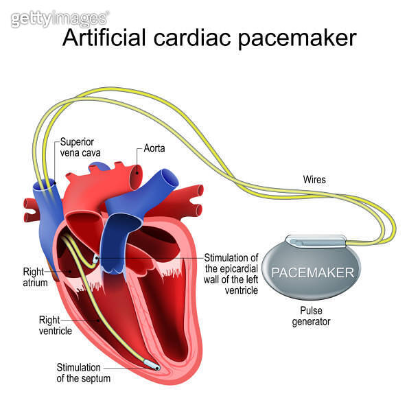 Artificial cardiac pacemaker. Heart implant. 이미지 (1702697839) - 게티이미지뱅크