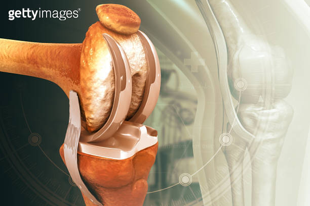 Human knee replacement surgery. Knee joint treatment. Knee injury. 3d ...