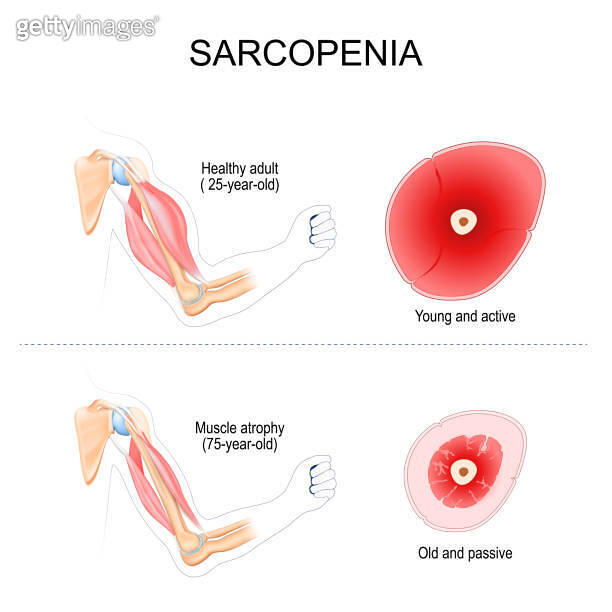 sarcopenia. muscle atrophy (1607645486) - 게티이미지뱅크