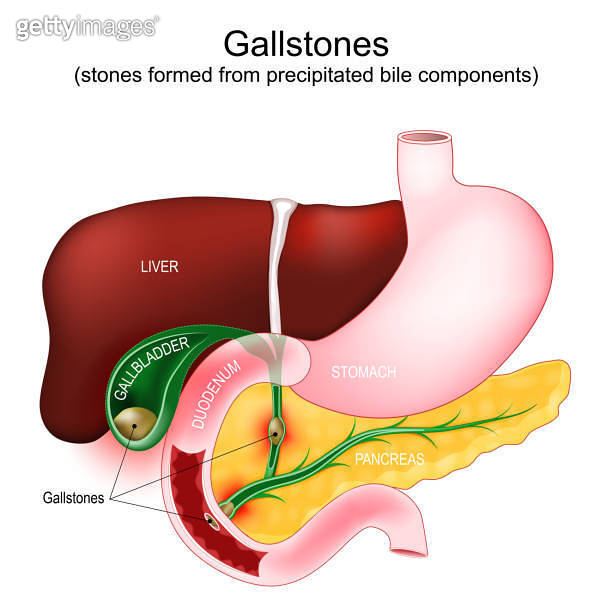 Gallstones. Parts of a digestive system: gallbladder, duodenum, stomach ...