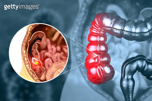 Colon cancer. Colon Polyp Removal. Endoscope inside colonoscopy for ...