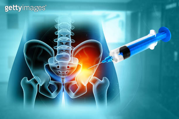 Hip Joint Injection, Treatment of the Hip joint, Pain relief, Bones of ...