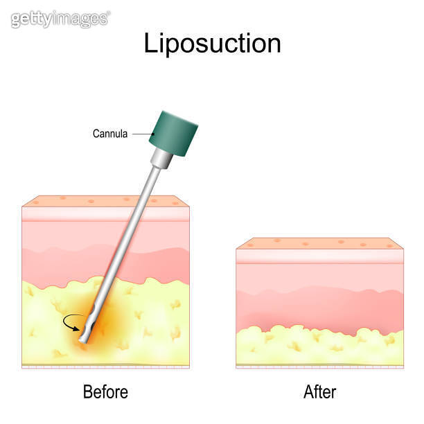Liposuction procedure. 이미지 (1744149914) - 게티이미지뱅크