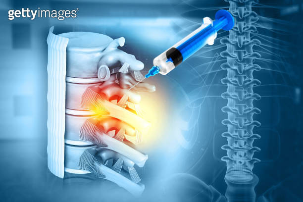 3d illustration of a lumbar spine injection (1725805868) 일러스트, 무료 일러스트 ...