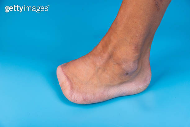 Amputation of all toes of a diabetic man's foot, diabetic foot, shampoo ...