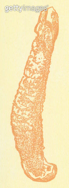 Medical Illustration of the Effects of Syphilis and Prescribed Mercury ...