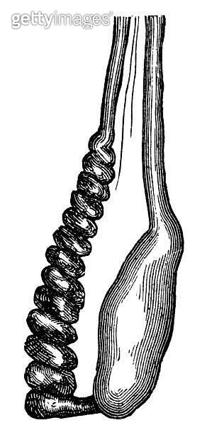 Medical Illustration of a Human Testicle with Atrophy - 19th Century ...