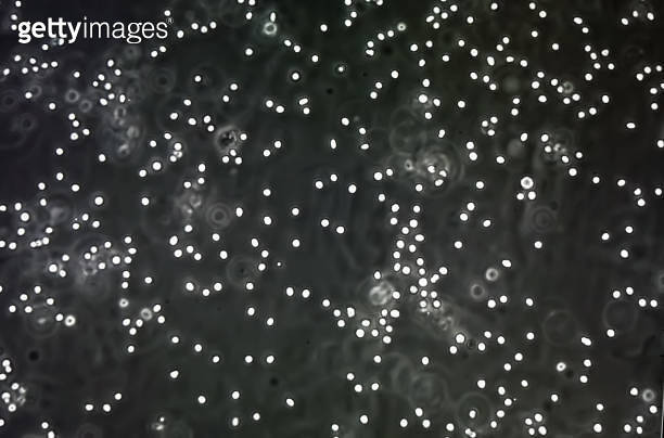 Microscopic image of urinalysis showing plenty Pus cells and RBC ...