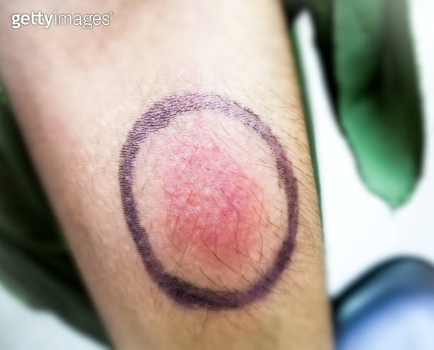 Mantoux vaccination, Closeup view photography of patient arm with red ...