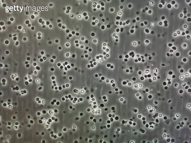 Microscopic image of urinalysis showing plenty Pus cells and RBC ...