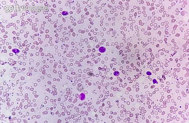 Blood Film: RBC: Hypochromic, anisocytosis with microcytes, target cell ...