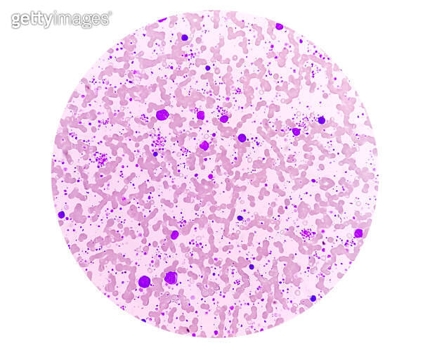 Chronic myeloid leukemia (CML) in accelerated phase with thrombocytosis ...
