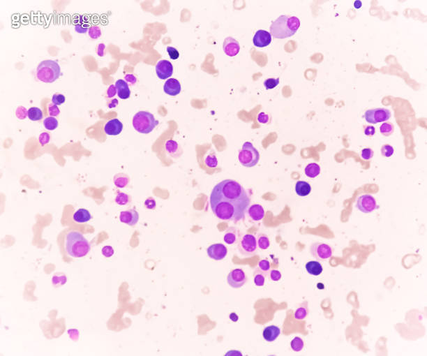 Microscopic view of bone marrow slide showing Multiple myeloma, also ...