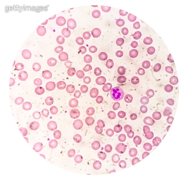 Photomicrograph: Suggestive of megaloblastic anemia to rule out ...