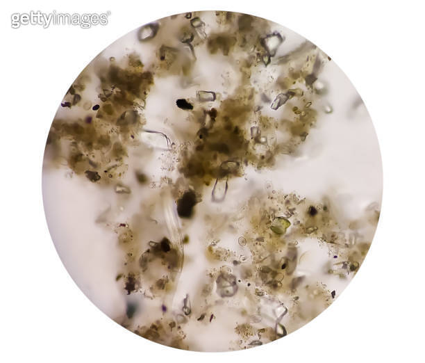Schistosoma Haematobium Parasite ova in human urine specimen under ...