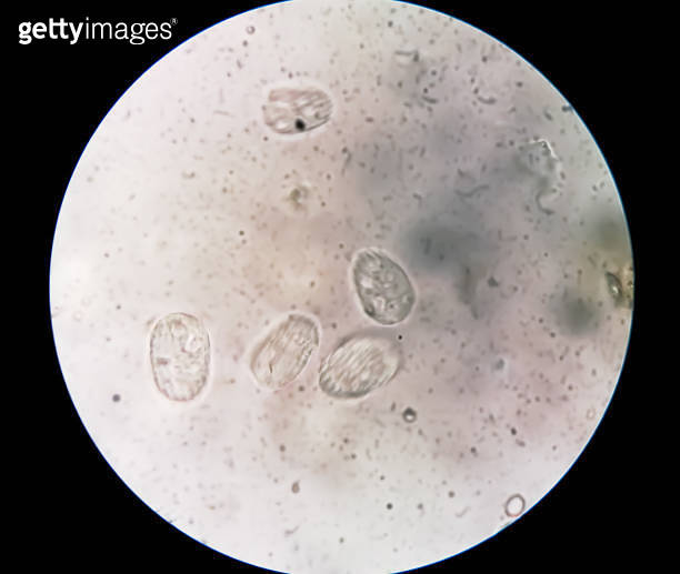 Schistosoma Haematobium Parasite ova in human urine specimen under ...
