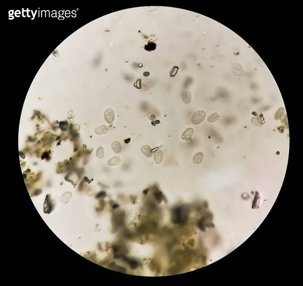 Schistosoma Haematobium Parasite ova in human urine specimen under ...