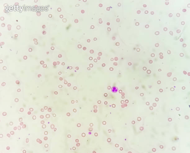 Photomicrograph of hematological slide showing Bicytopenia, a condition ...