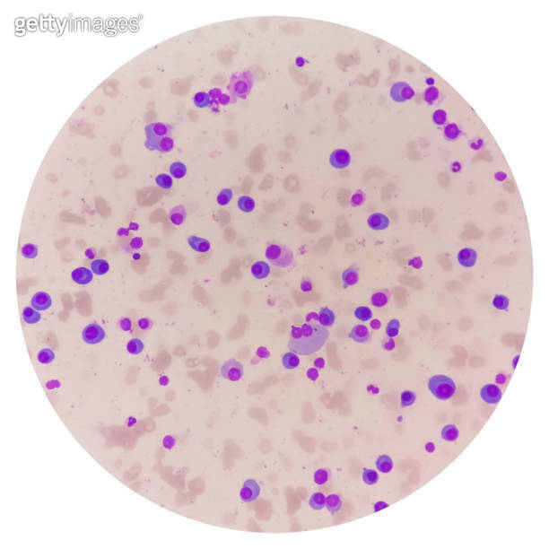 Microscopic view of bone marrow slide showing Multiple myeloma, also known as myeloma, is a type ...