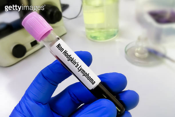 Scientist hold blood sample for Non-Hodgkin lymphoma (NHL) test. Non ...